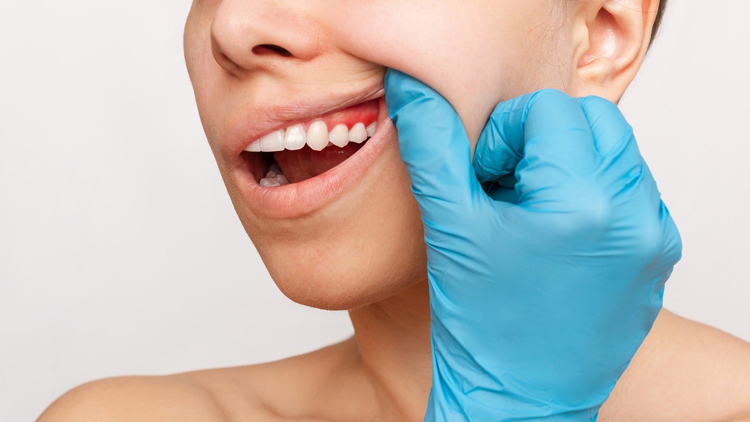 Gingivitis (Gum Disease): Symptoms, Causes, and Treatments