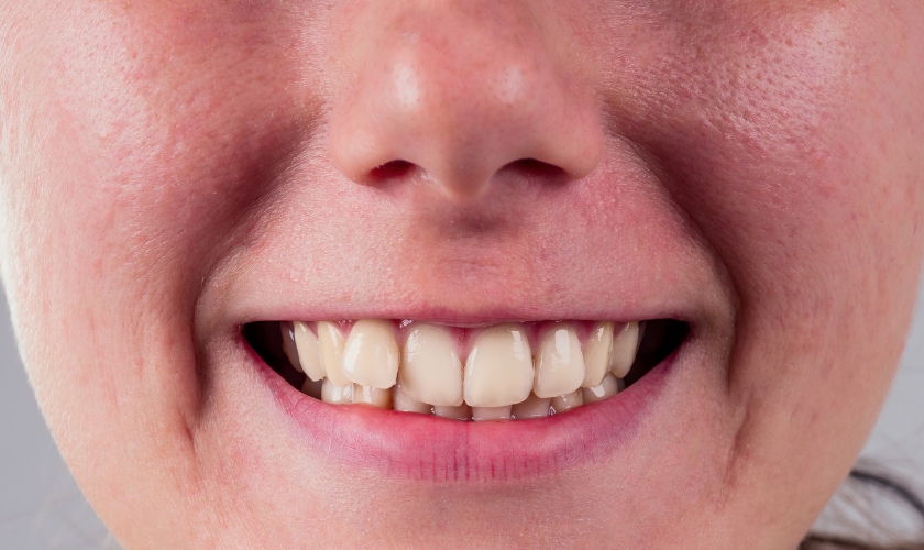 Fix Crooked Teeth with a Cosmetic Dentist?